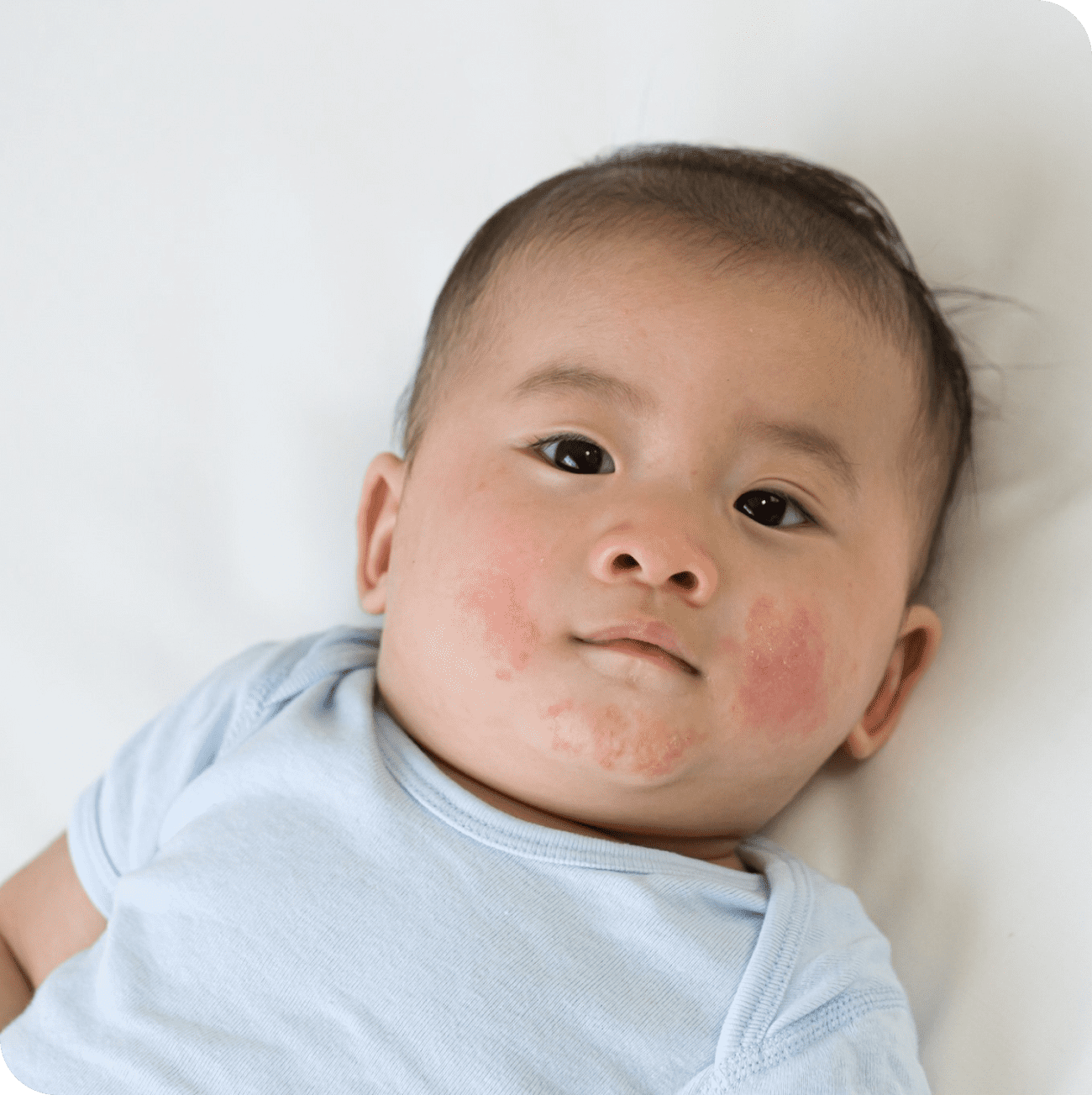 How to spot nappy rash? - Sudocrem Indonesia